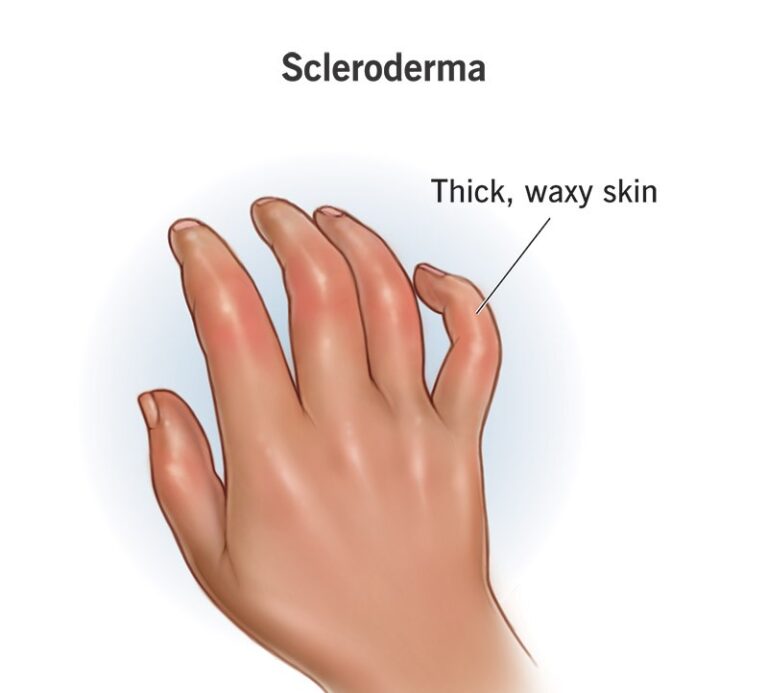 Morphea (Localized Scleroderma): Understanding the Basics of This Rare ...
